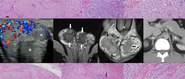Testicular Adrenal Rest Tumors In A Patient With Congenital Adrenal