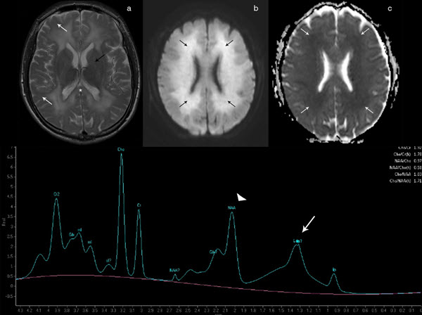 Delayed leukoencephalopathy after acute carbon monoxide intoxication ...