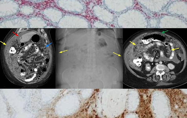 Peritoneal Carcinomatosis Arising from Primary Anorectal Melanoma ...