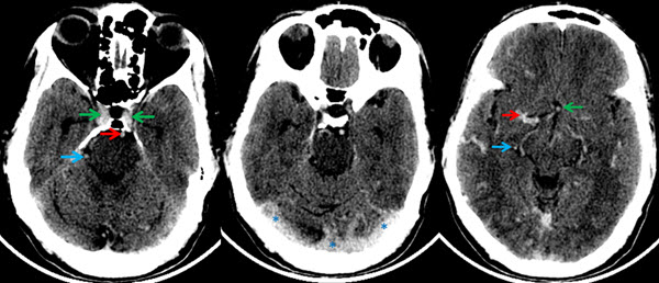 Non-Enhanced CT Mimicking Contrast Enhanced CT - A Case Report on ...