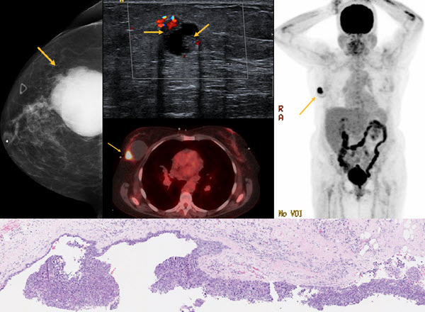 Complex Solid And Cystic Breast Cancer A Series Of Six Case Reports complex-solid-and-cystic-breast-cancer-a-series-of-six-case-reports