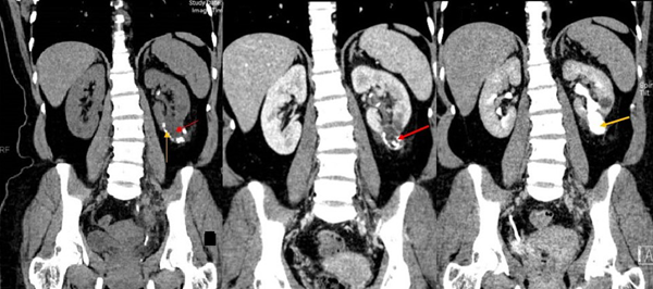 Type 2 calyceal diverticulum with an unusual appearance in the lower ...