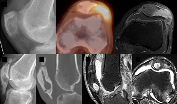 Lucent Patellar Lesions: A Pictorial Review | Lu | Journal of Radiology ...