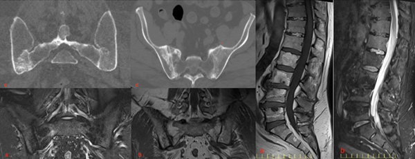 Diffuse Idiopathic Skeletal Hyperostosis and Ankylosing Spondylitis: A ...